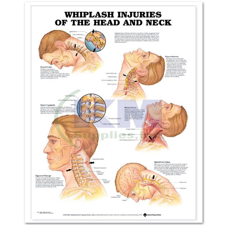 Whiplash Injuries Of The Head And Neck Anatomical Chart – KM Supplies